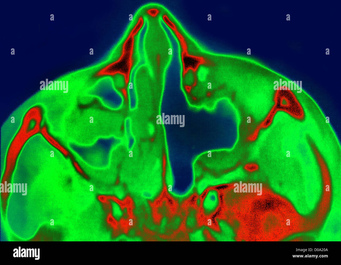 Sinus ethmoïdal Banque de photographies et d’images à haute résolution ...