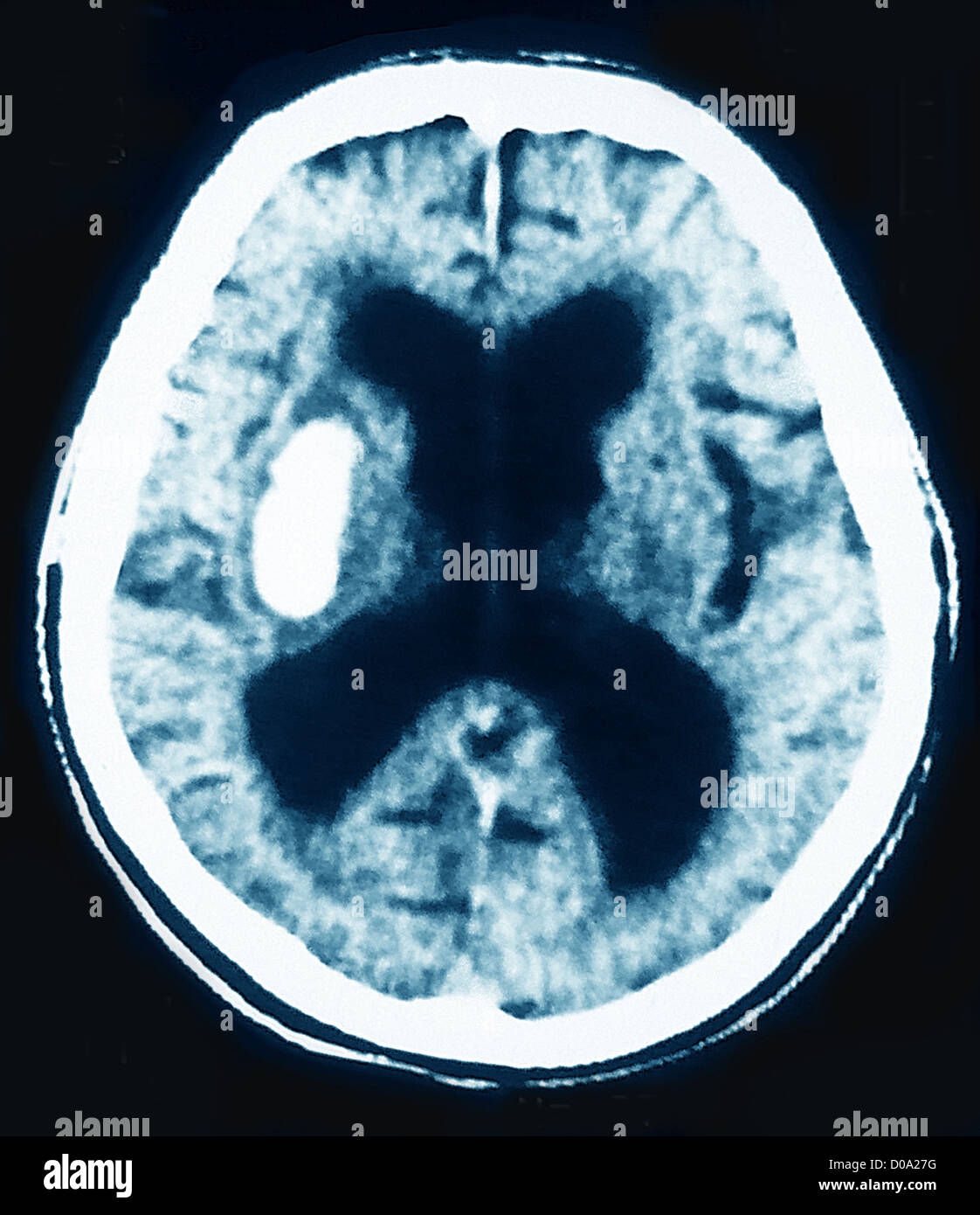 Scanner le sang au cerveau Banque de photographies et d’images à haute ...