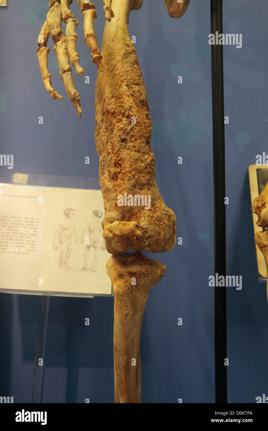 Proteus syndrome Banque de photographies et d’images à haute résolution ...