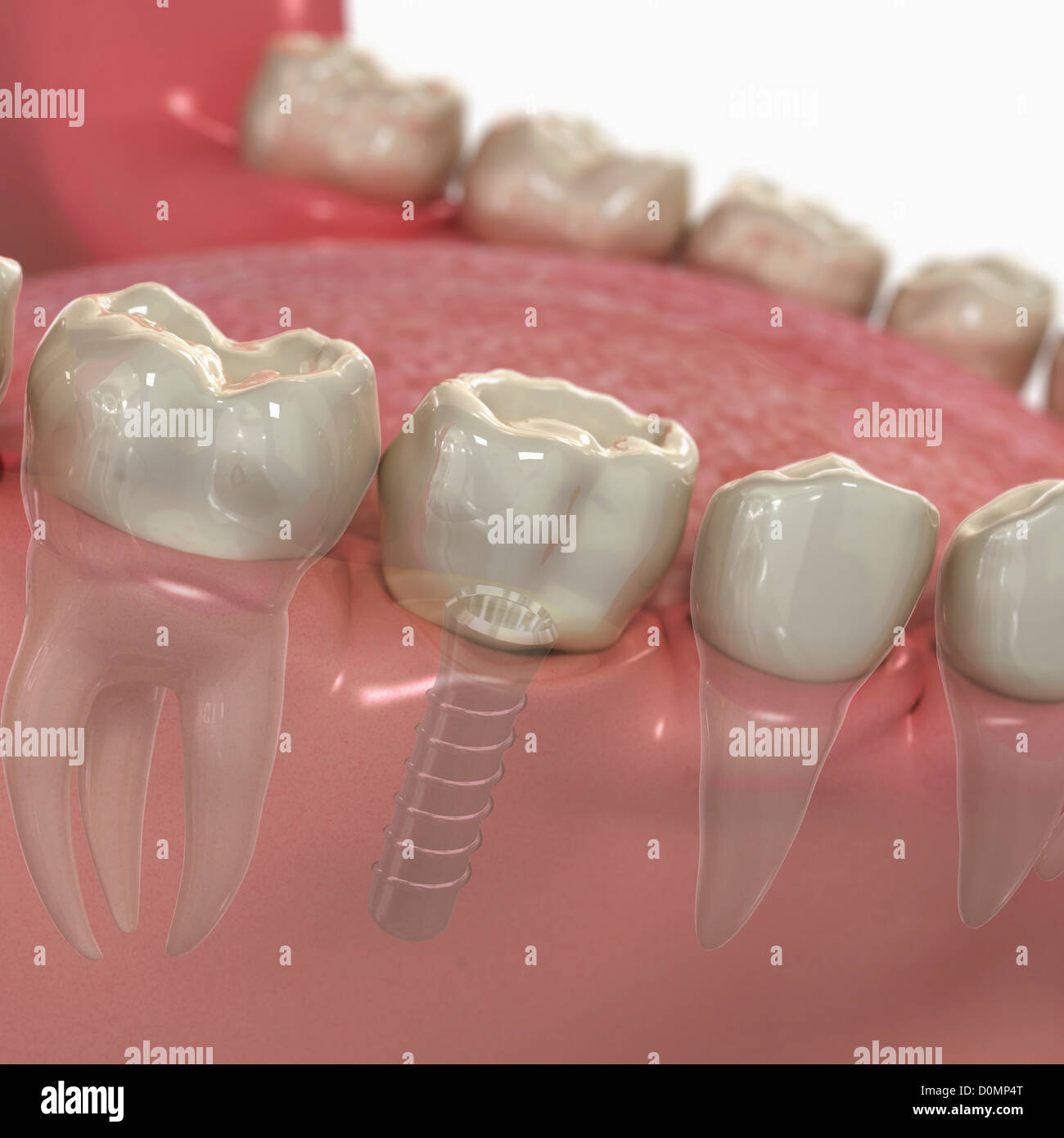 Modèle anatomique afficher un implant de dent dans la mâchoire ...