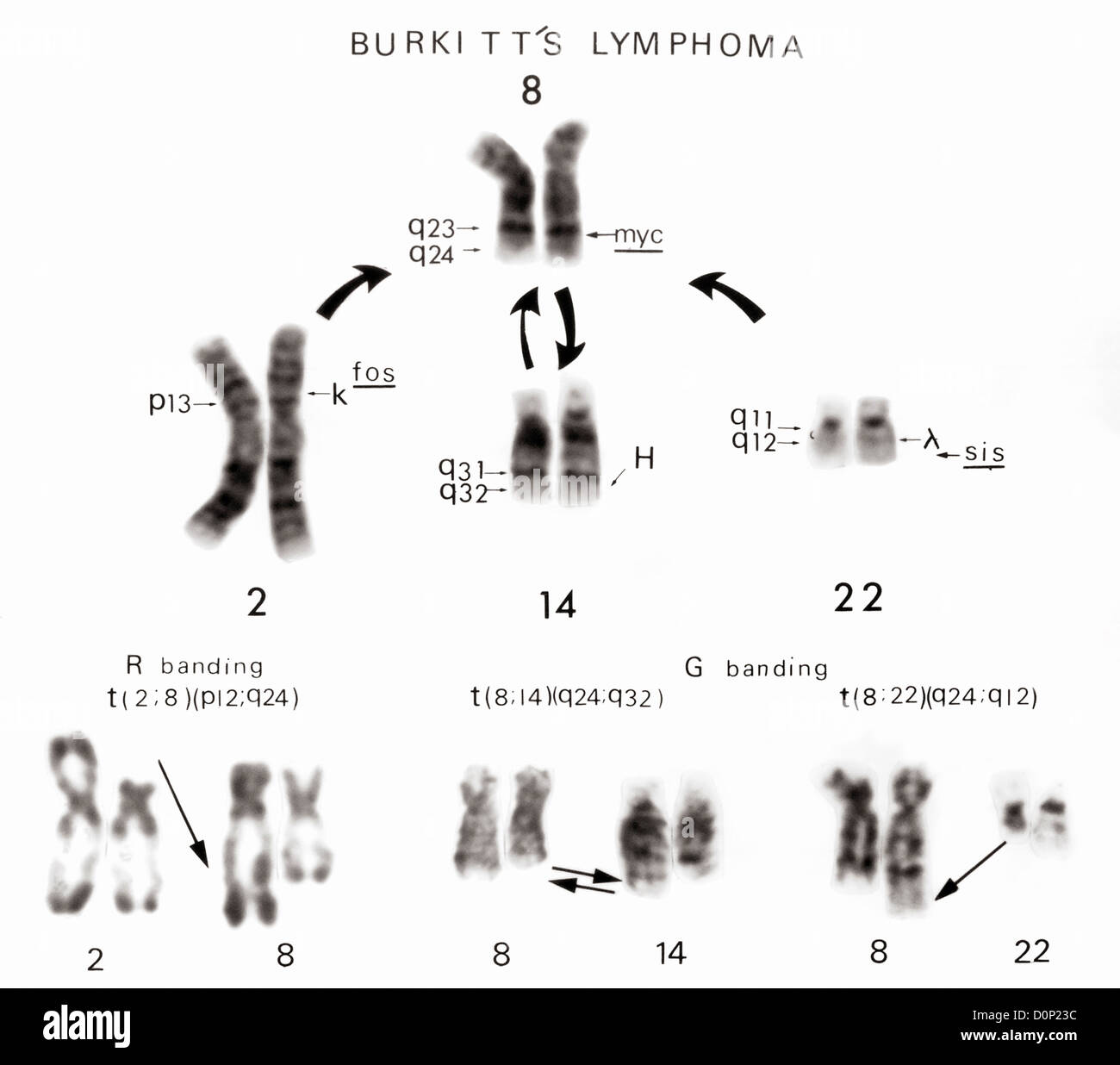 Un caryotype partielle montrant translocations impliquant le chromosome ...