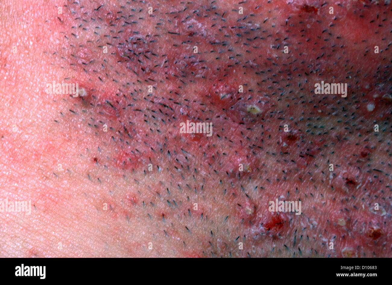 Impetigo cheveux Banque de photographies et d’images à haute résolution ...
