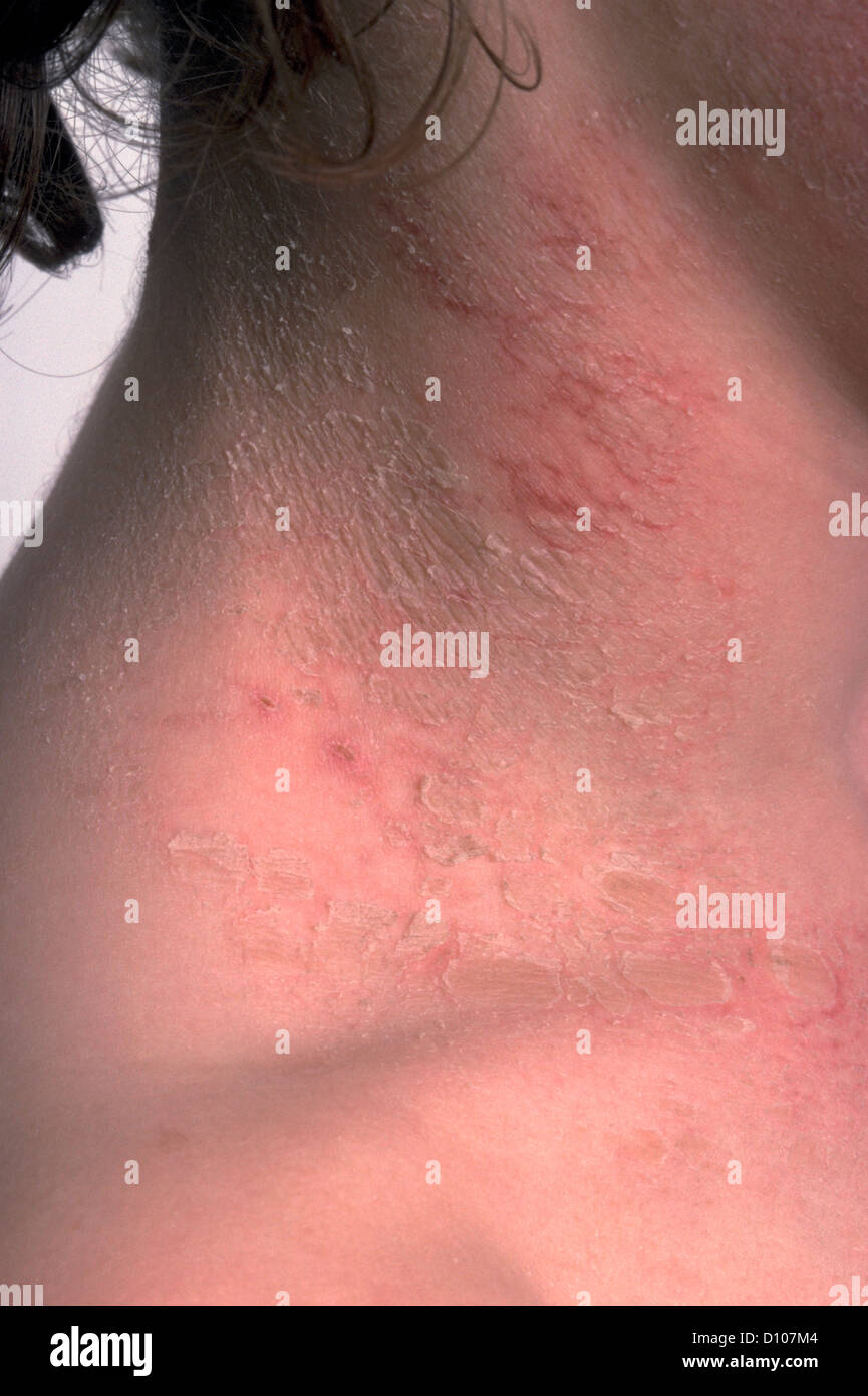 Dermatite de contact Banque de photographies et d’images à haute ...