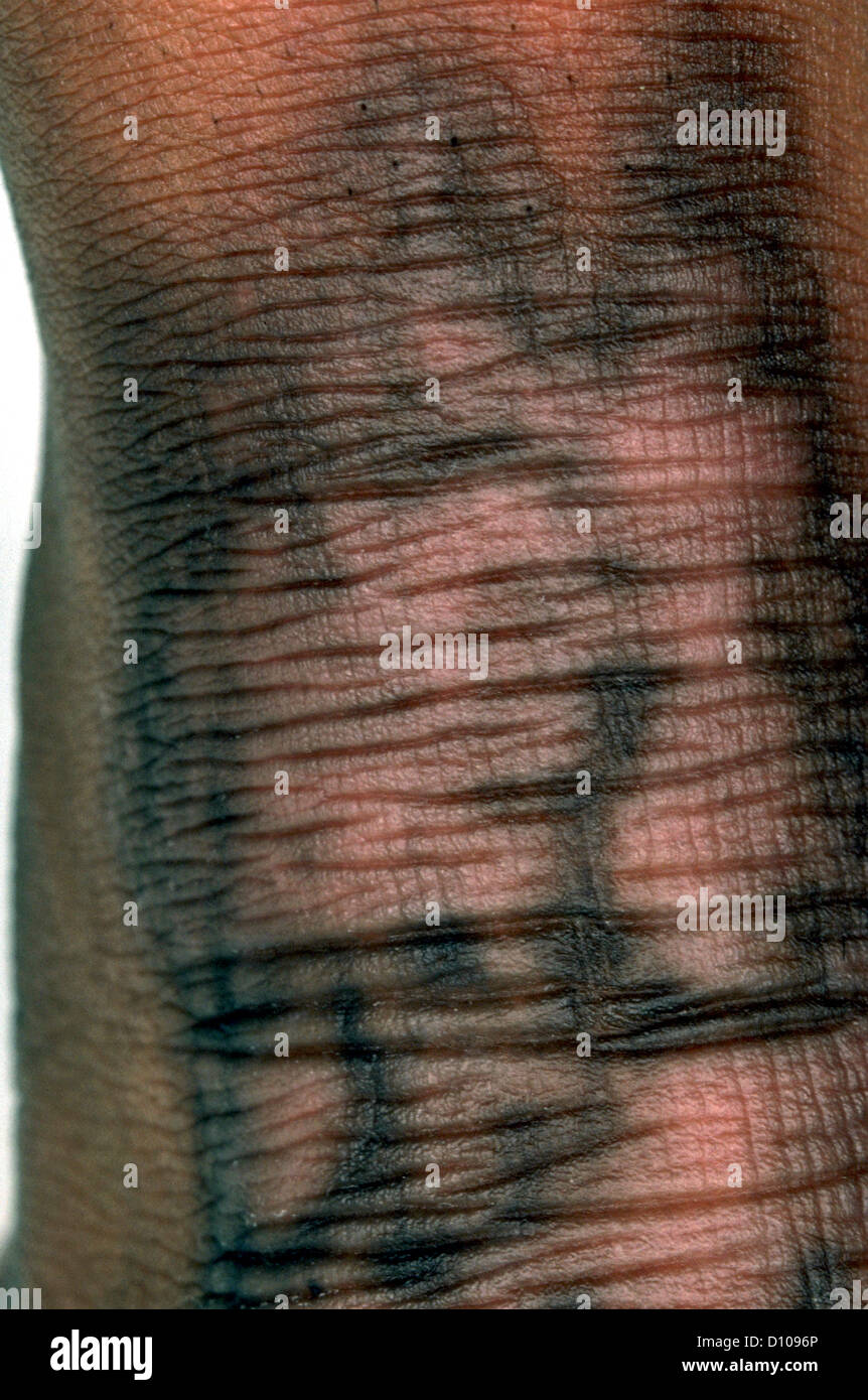 Hyperkeratosis dermatology Banque de photographies et d’images à haute ...