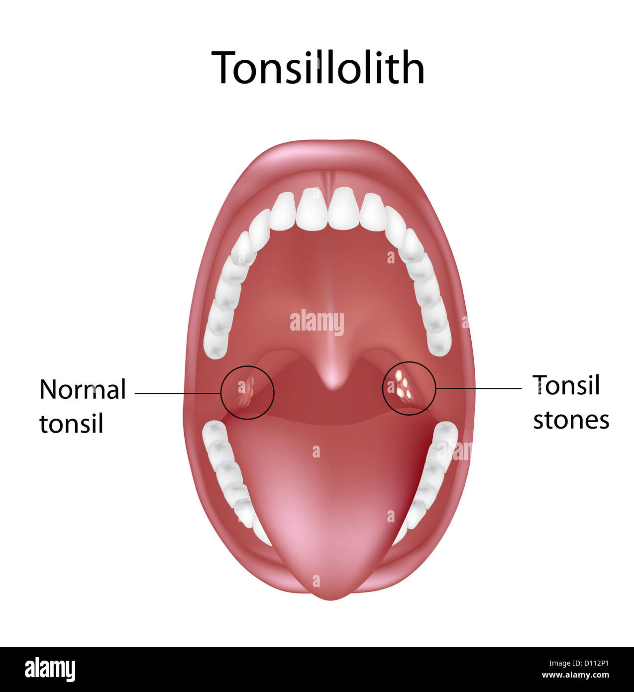 Amygdale palatine humaine Banque de photographies et d’images à haute ...