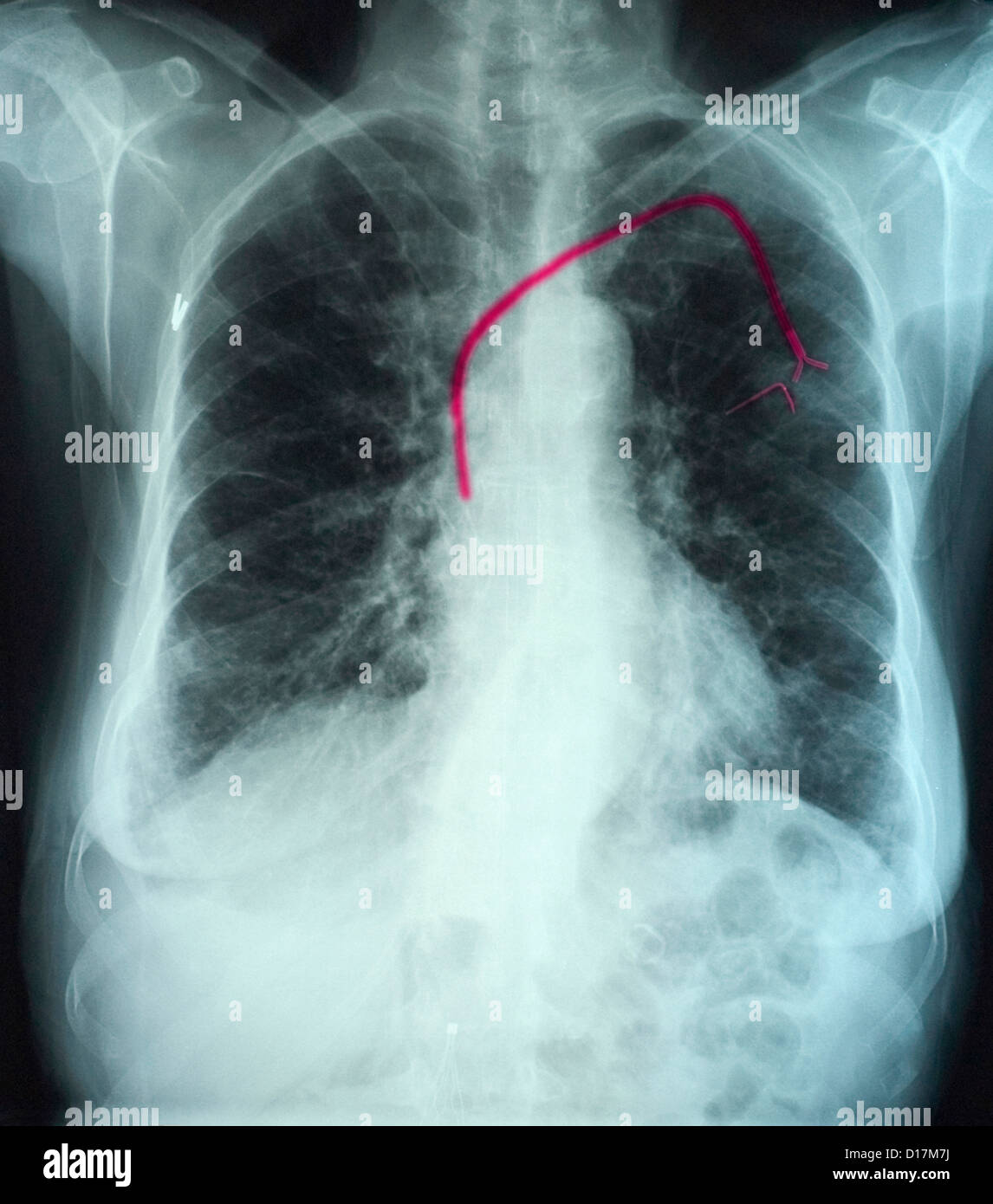 Rx thorax montrant l'orifice de perfusion dans le coeur Photo Stock - Alamy