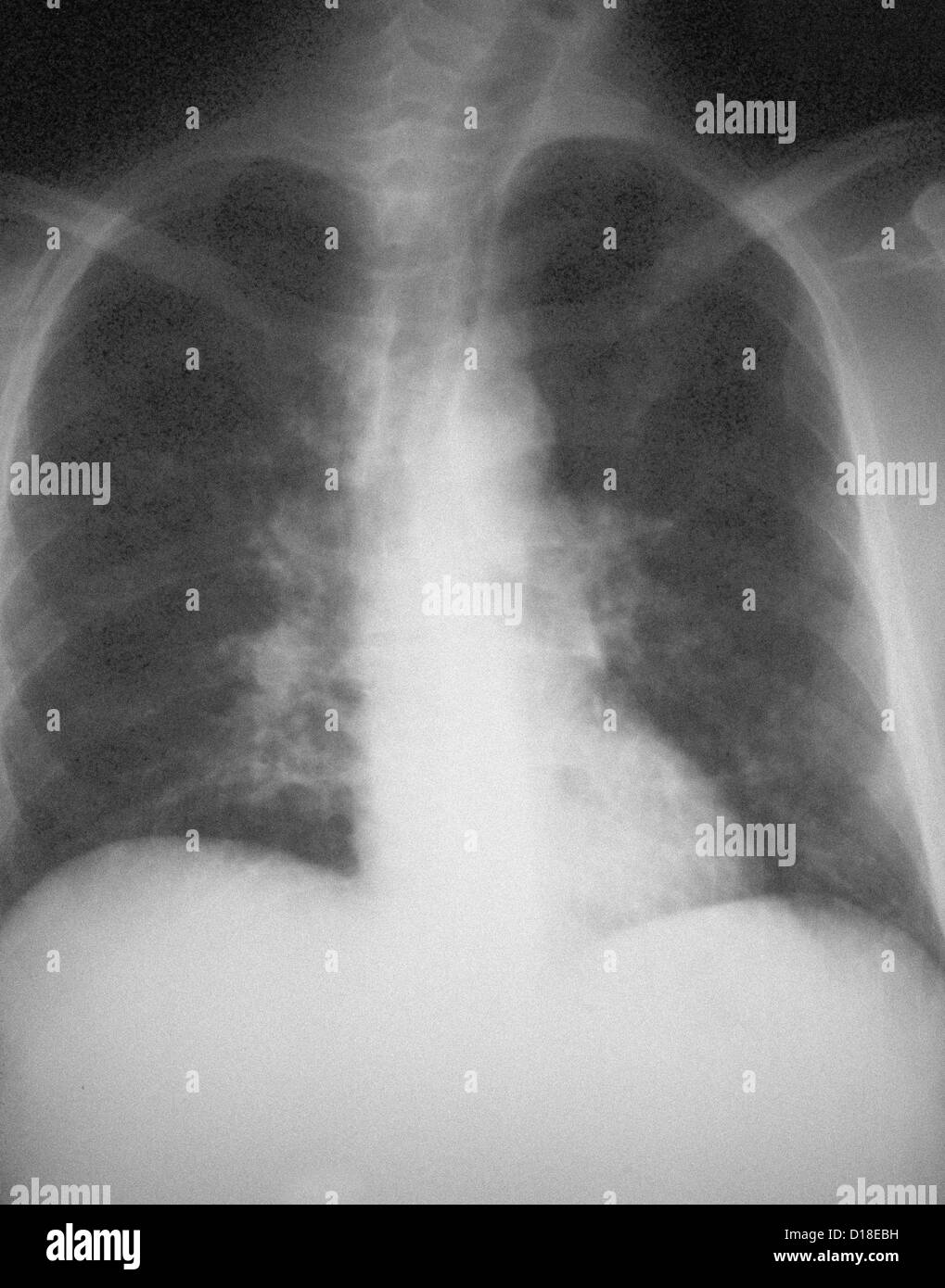 Sida patient avec la pneumonie à pneumocystis carinii Photo Stock - Alamy