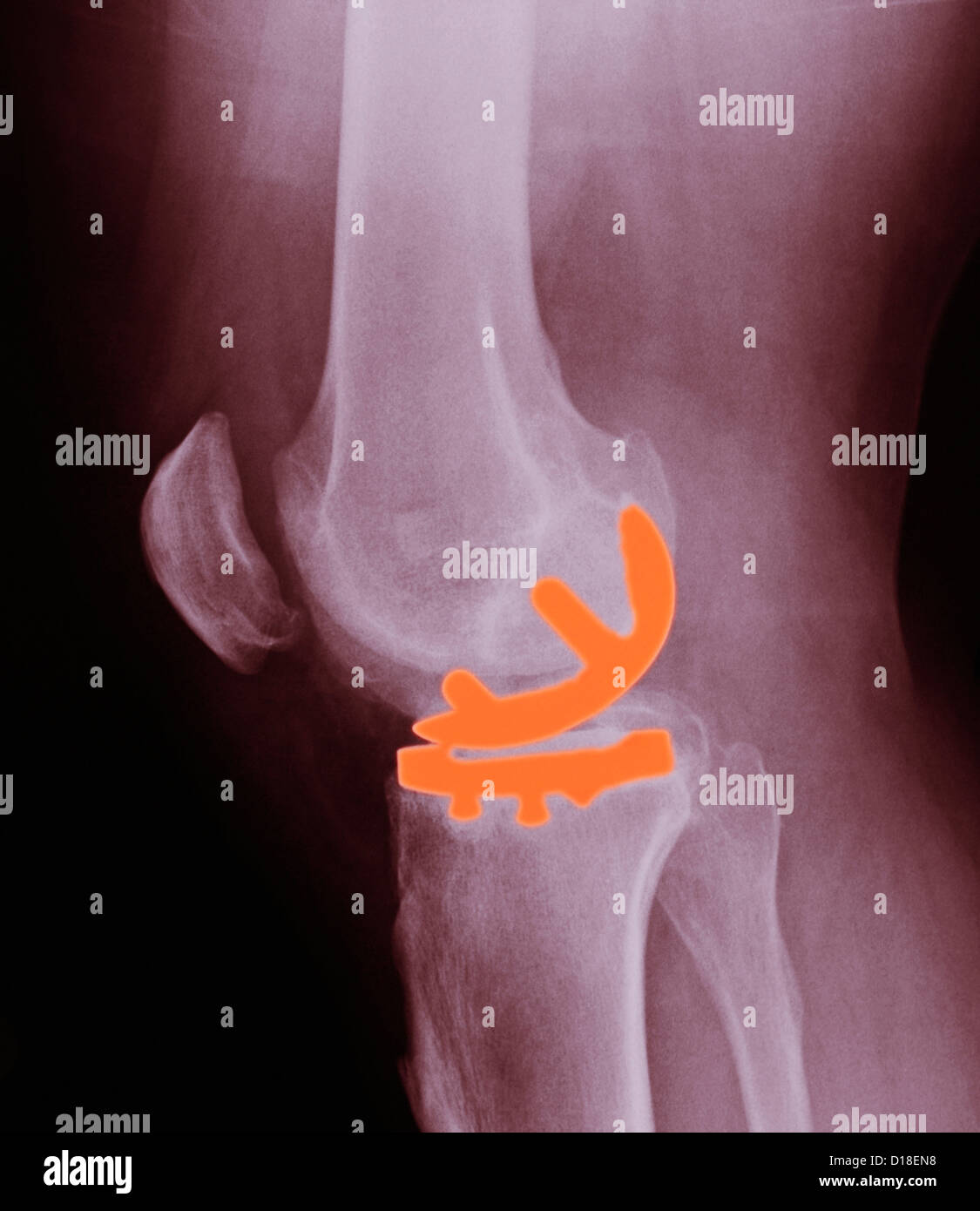 Medial Condyle Banque d'image et photos - Alamy