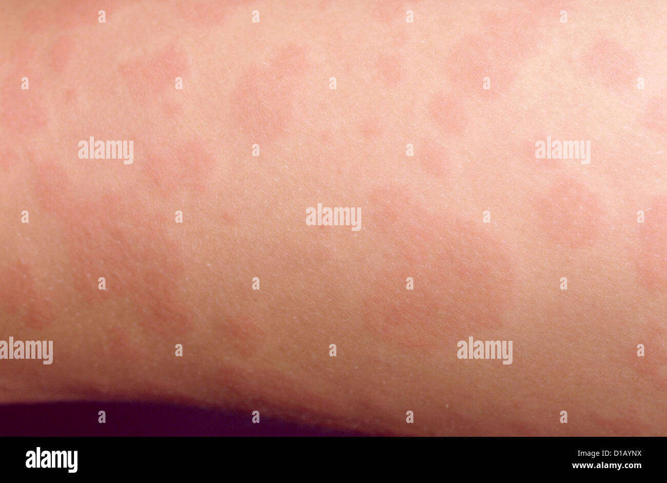 Syndrome de stevens johnson Banque de photographies et d’images à haute ...