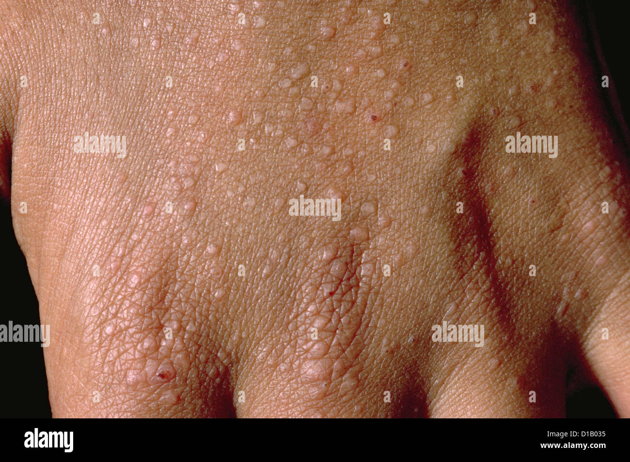 Papular rash Banque de photographies et d’images à haute résolution - Alamy