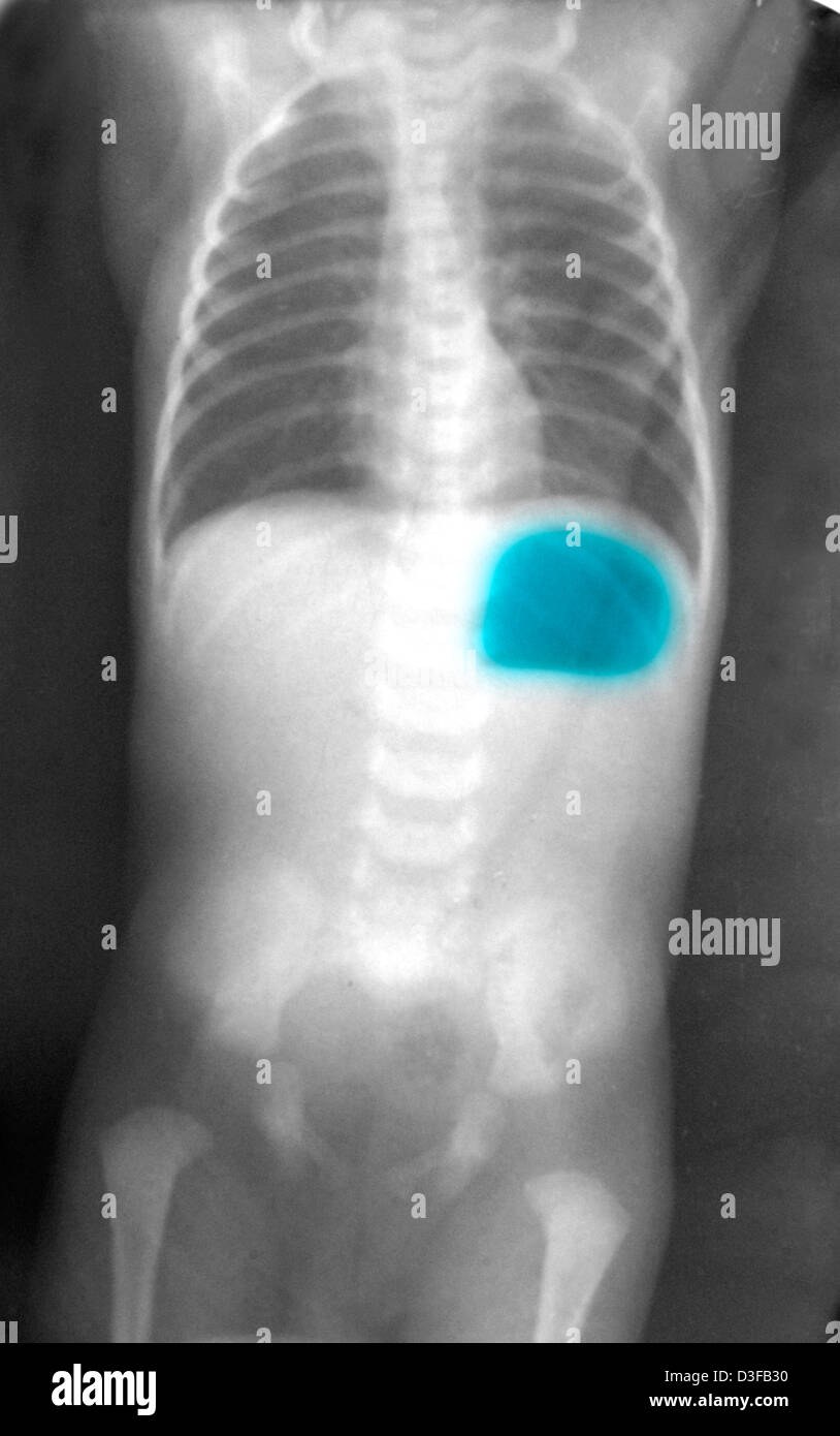 La sténose du pylore, l'abdomen xray Photo Stock - Alamy