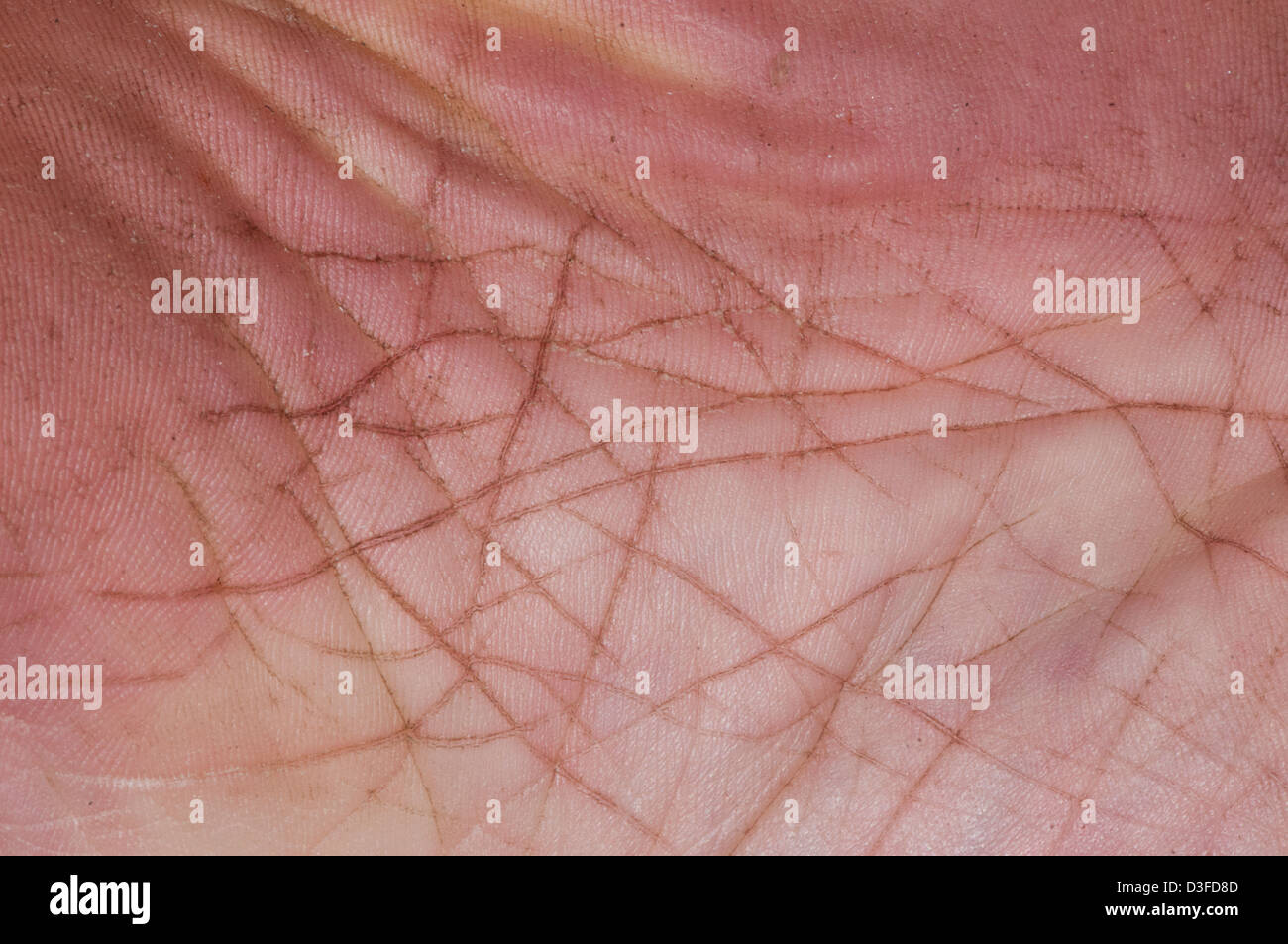 Hyperkeratosis dermatology Banque de photographies et d’images à haute ...