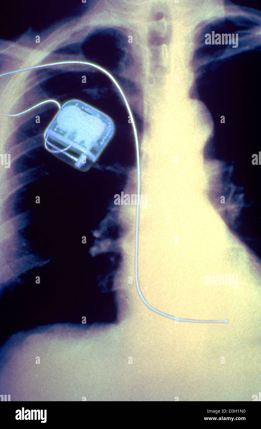 Radiographie du stimulateur cardiaque Banque de photographies et d ...