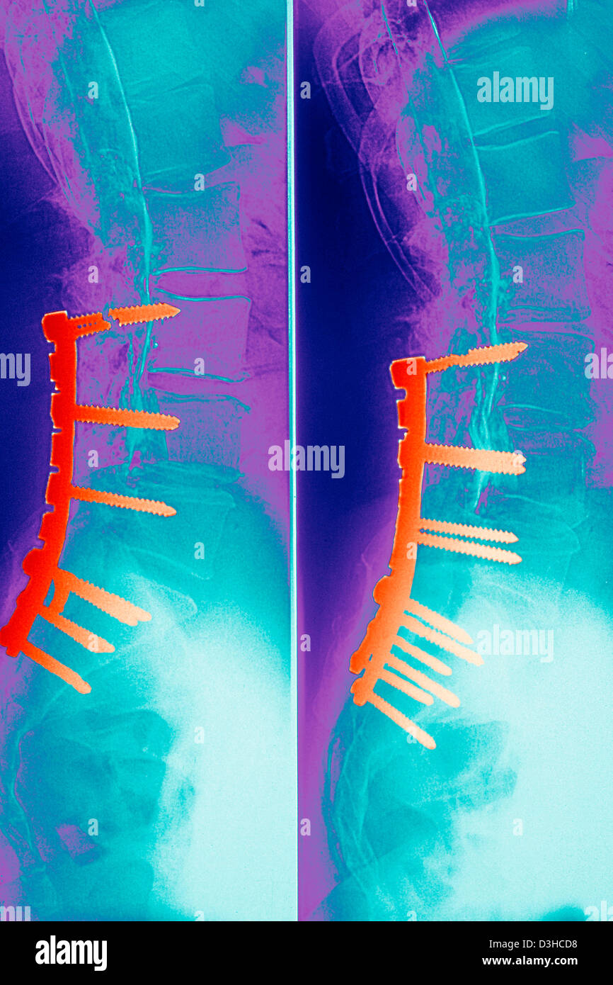 Arthrodèse lombaire Banque de photographies et d’images à haute ...