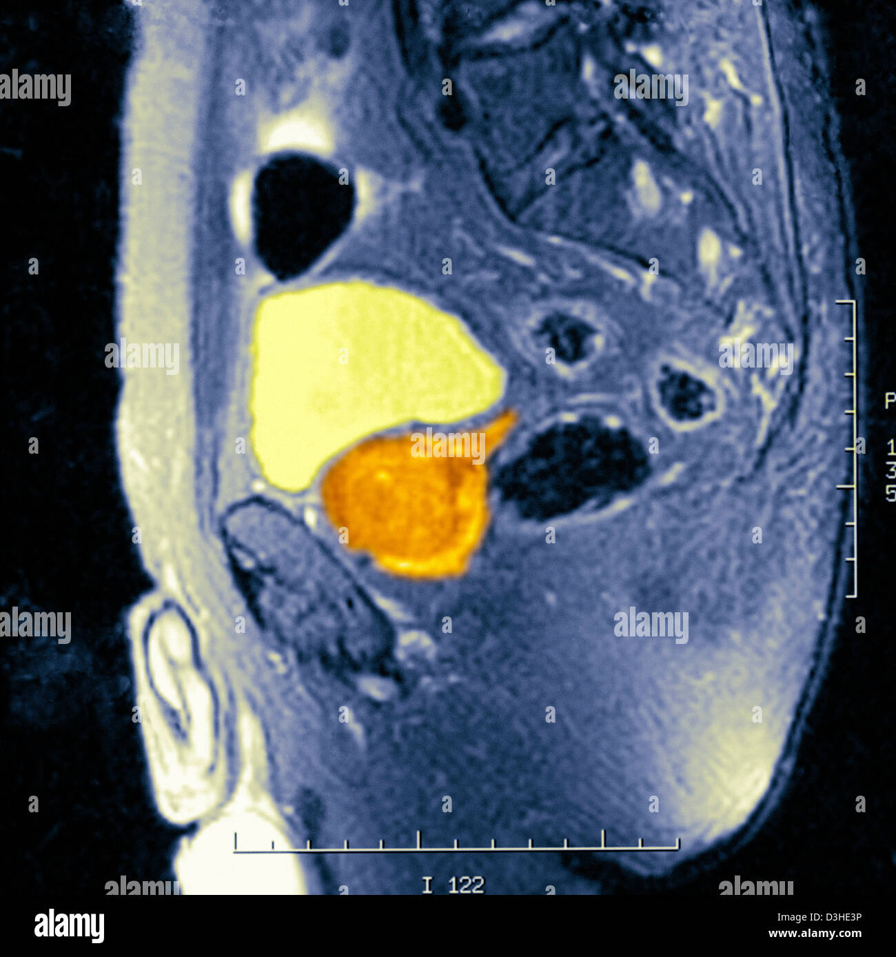 Hypertrophie prostatique Banque de photographies et d’images à haute ...