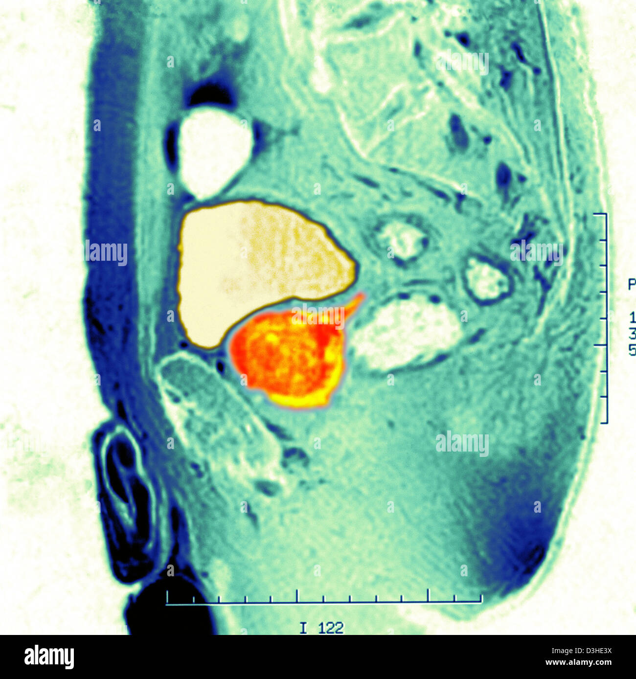 Prostate glands Banque de photographies et d’images à haute résolution ...