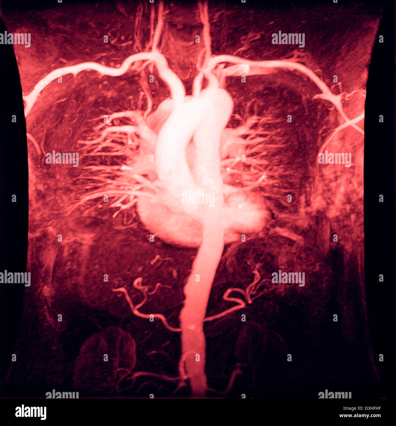 Vascularisation du coeur Banque de photographies et d’images à haute ...