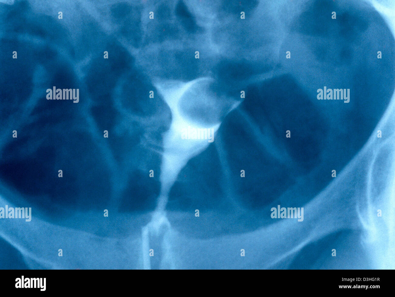 Fibrome utérin Banque de photographies et d’images à haute résolution ...