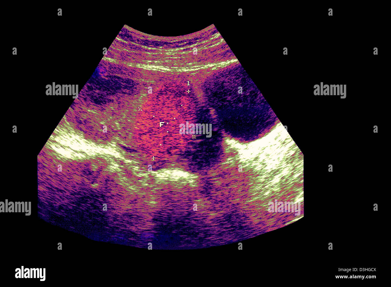 Fibrome utérin, l'échographie Photo Stock - Alamy