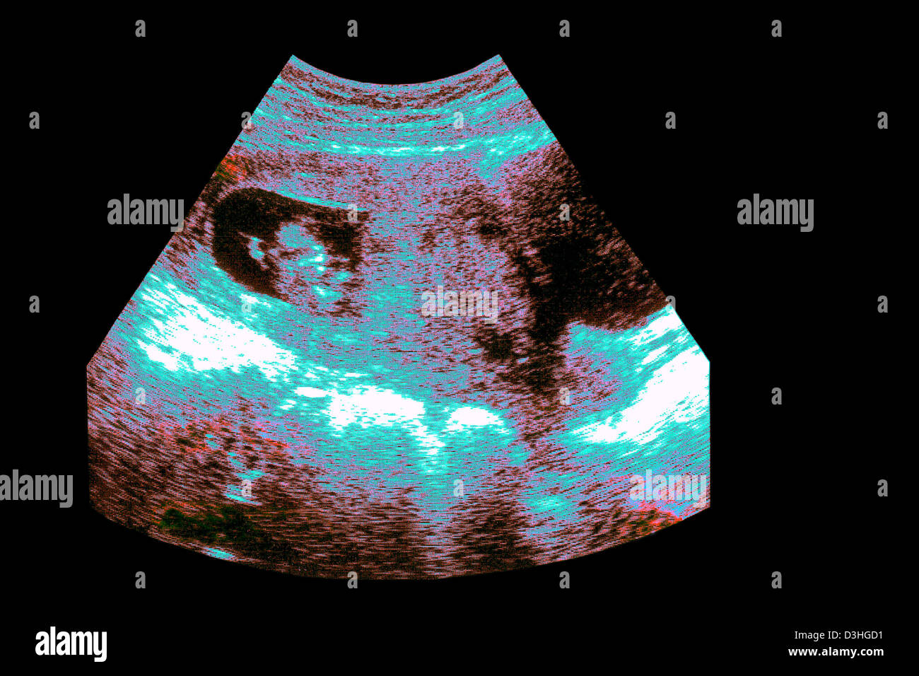 Fibrome utérin Banque de photographies et d’images à haute résolution ...