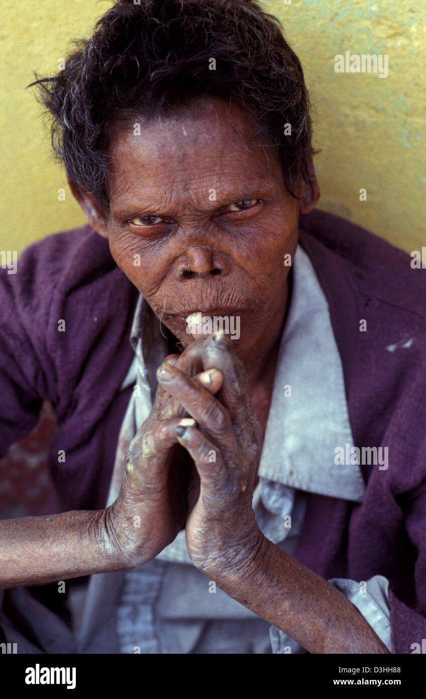 Woman leprosy leper Banque de photographies et d’images à haute ...
