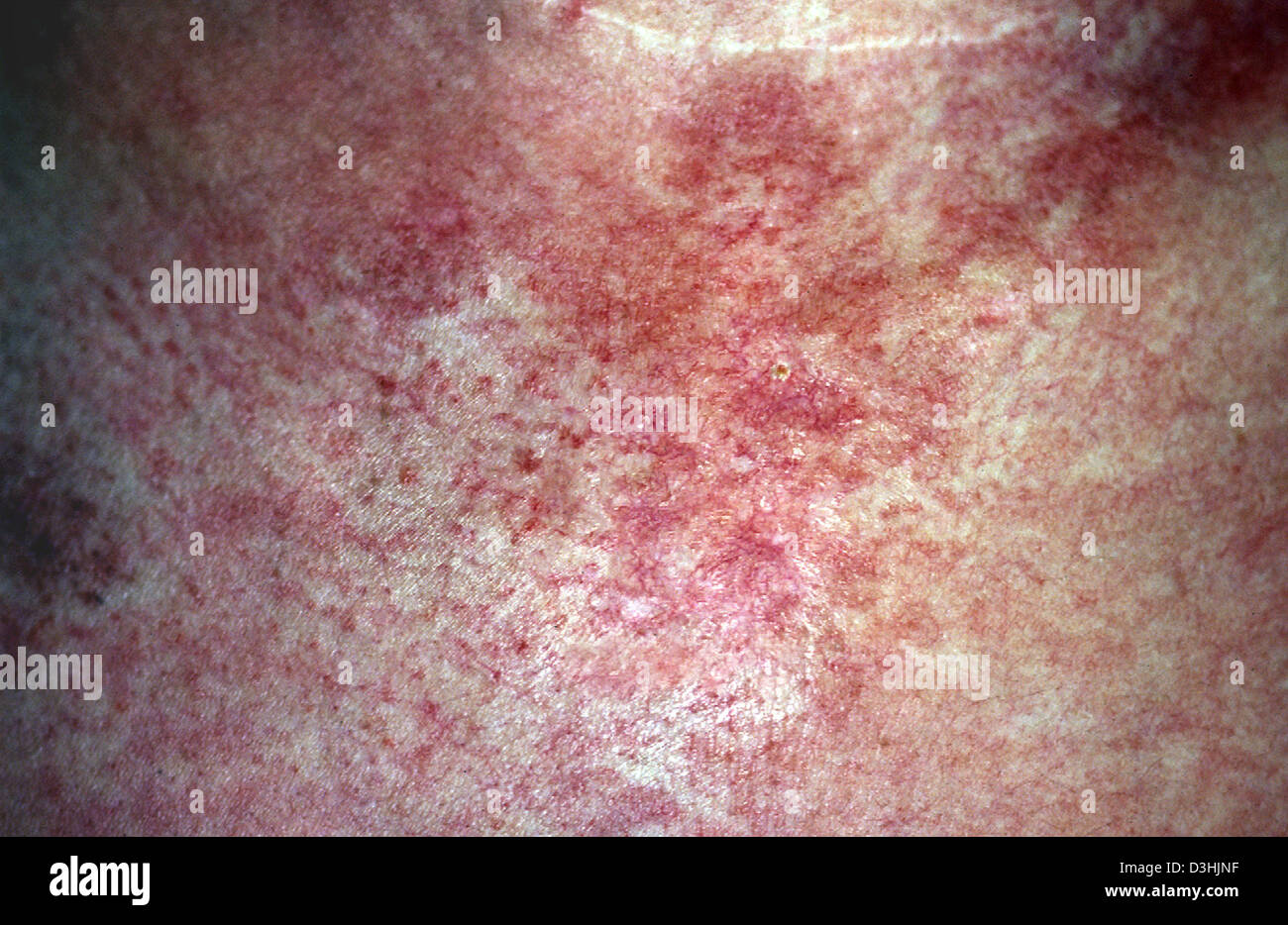 Erythematous rash Banque de photographies et d’images à haute ...