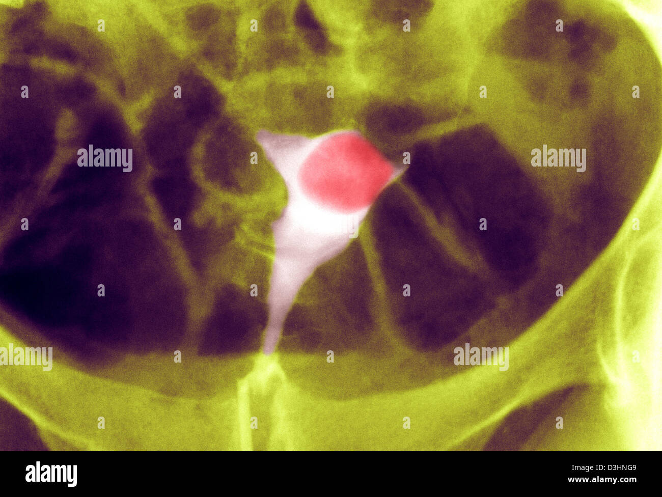 Uterine fibroma Banque de photographies et d’images à haute résolution ...