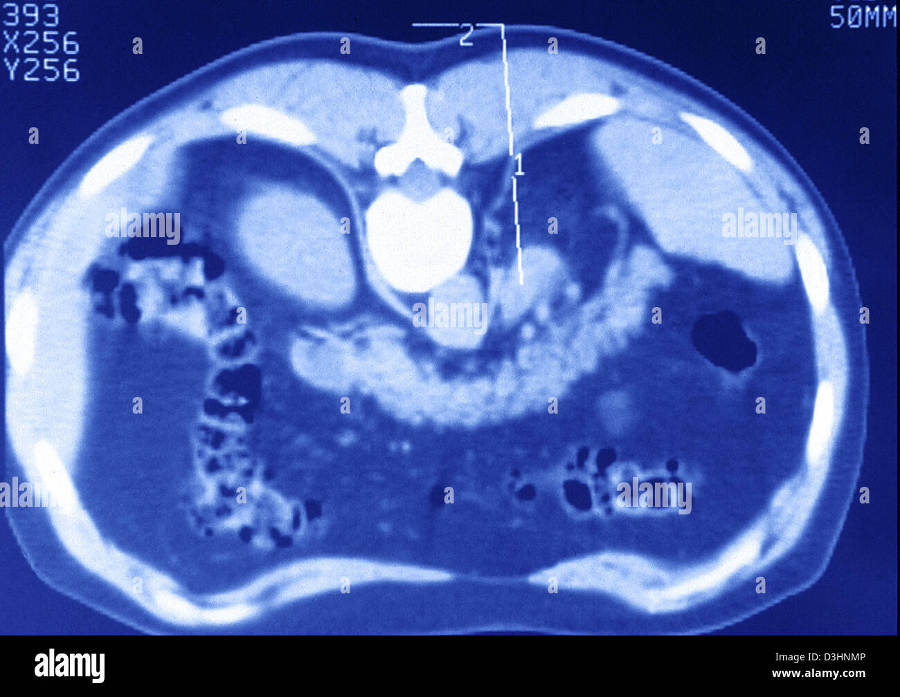 Test de biopsie Banque de photographies et d’images à haute résolution ...