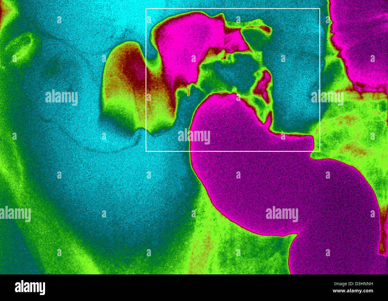 Cancer du sigmoïde Banque de photographies et d’images à haute ...