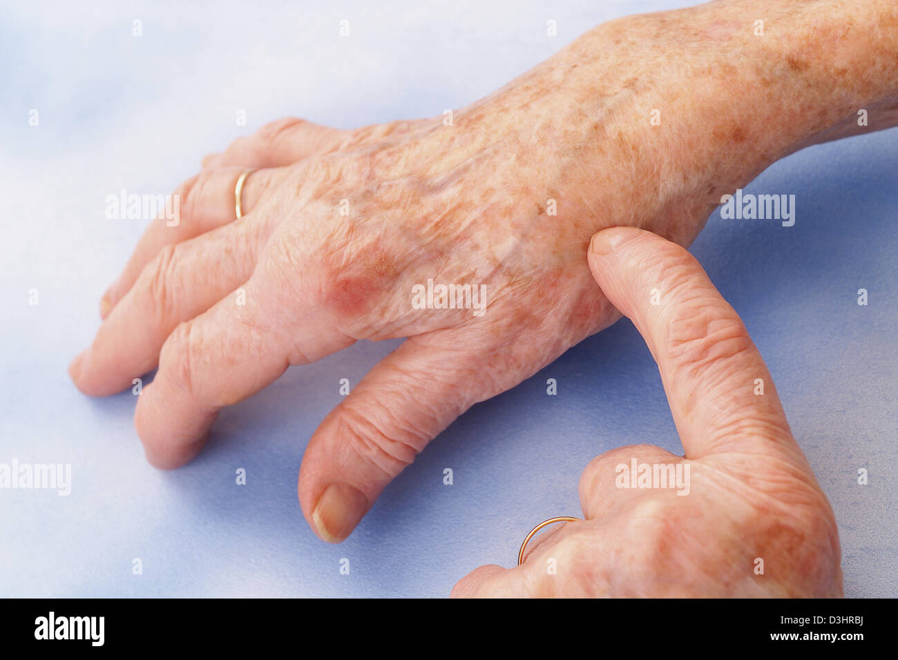 L'ARTHROSE DU POIGNET Photo Stock - Alamy