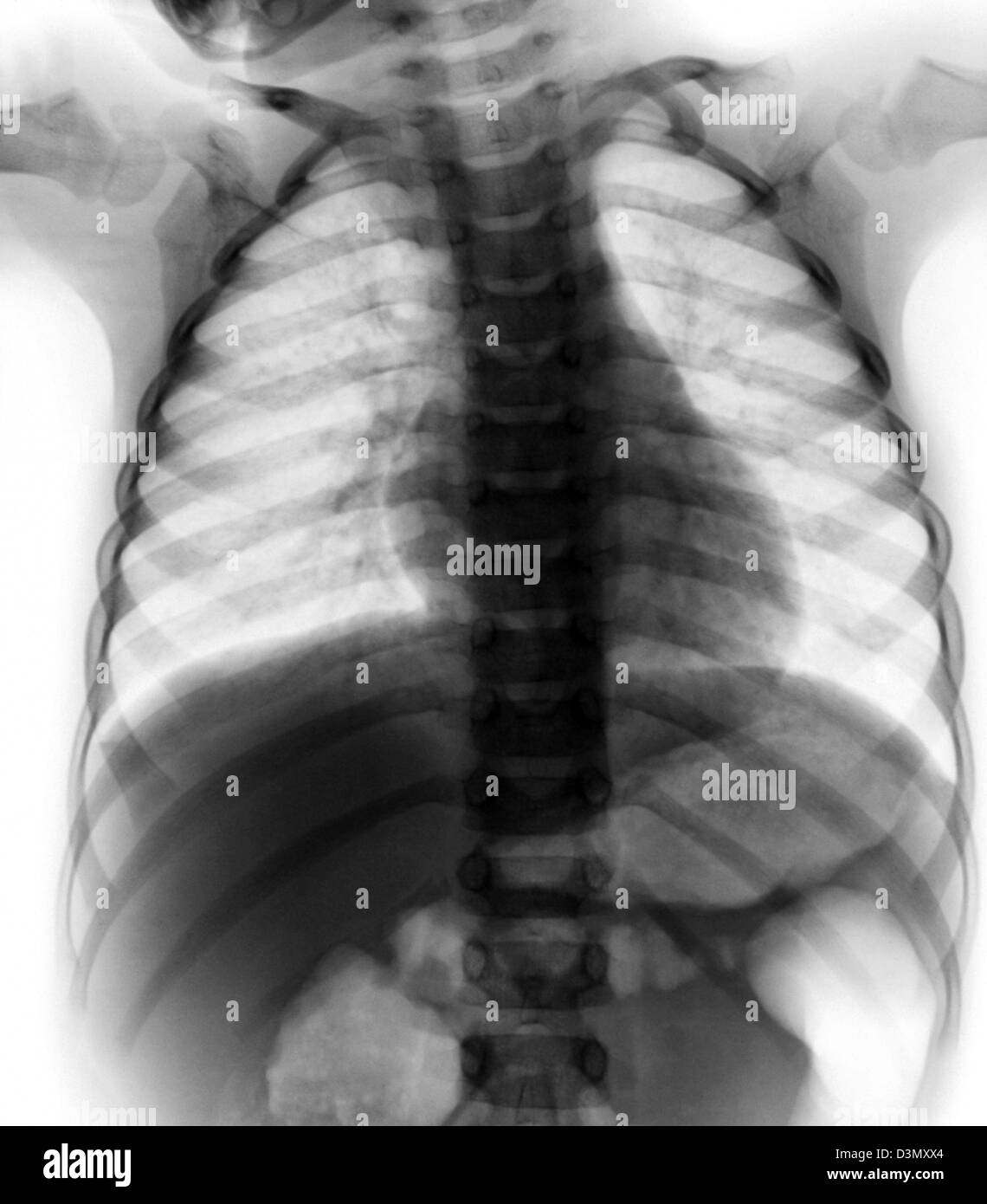 Radiographie thoracique normale Banque d'images noir et blanc - Alamy