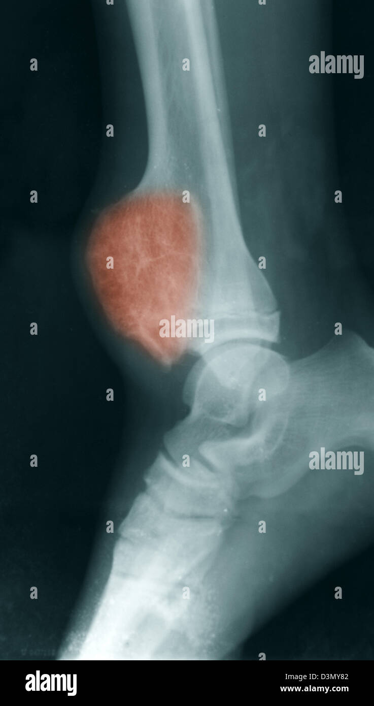 X-ray montrant une tumeur de l'extrémité distale du tibia Photo Stock ...