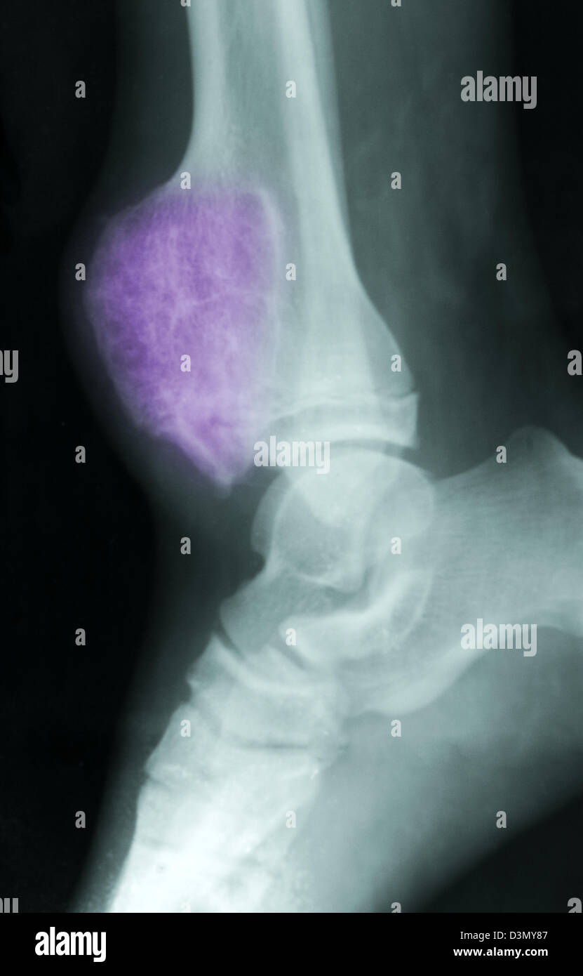 X-ray montrant une tumeur de l'extrémité distale du tibia Photo Stock ...