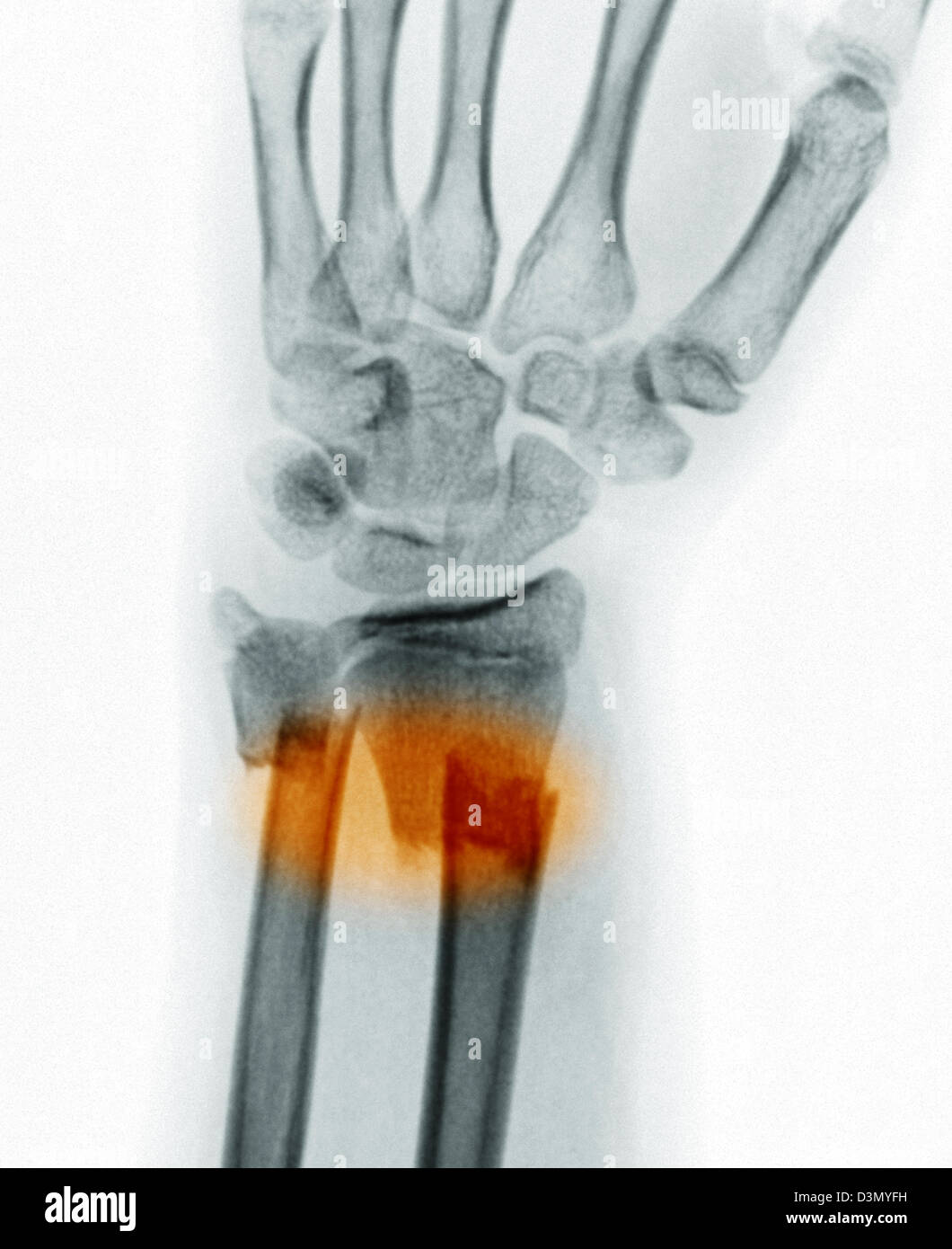 X-ray montrant une fracture de la partie distale du radius et cubitus ...