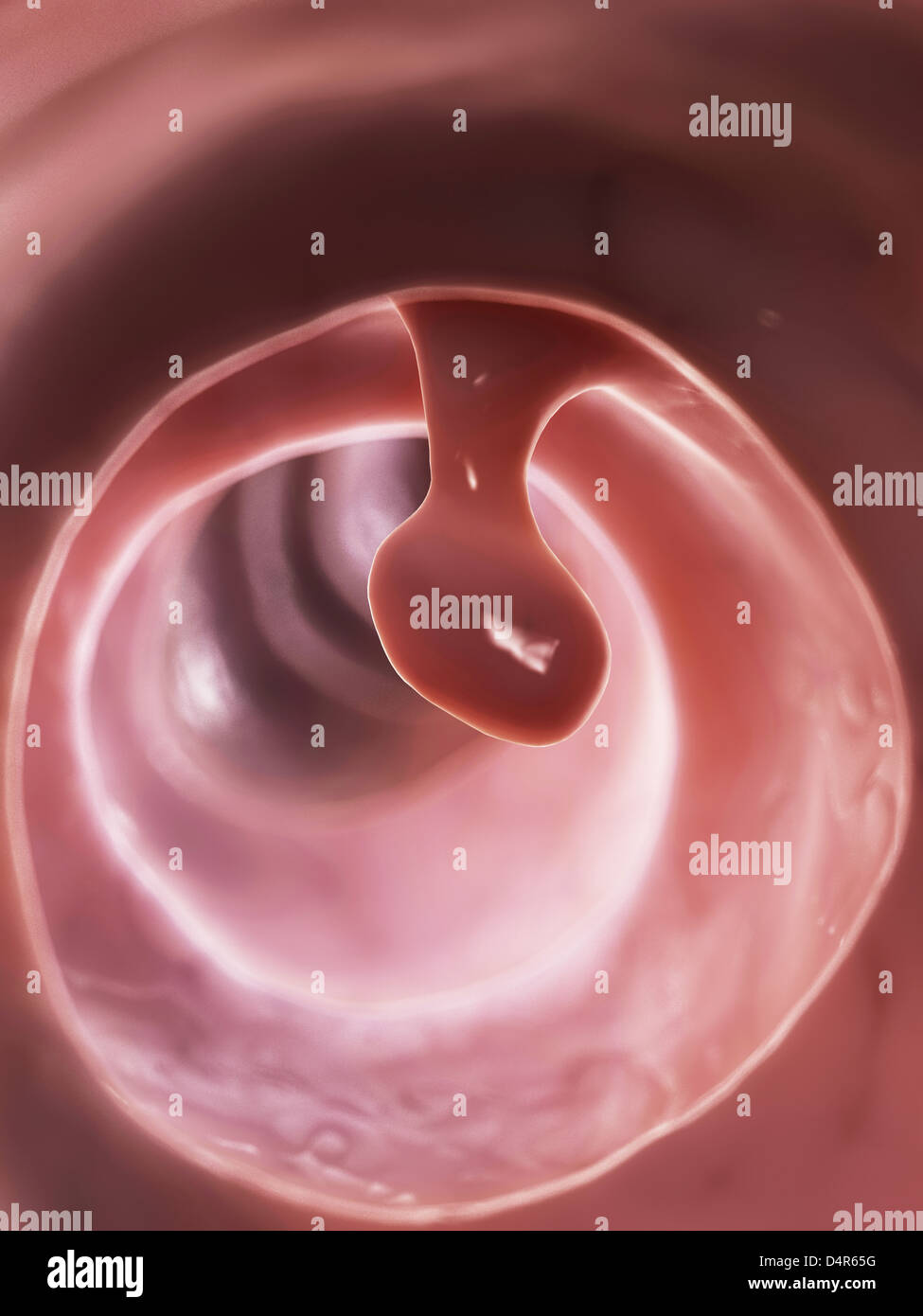 Polype colon Banque de photographies et d’images à haute résolution - Alamy