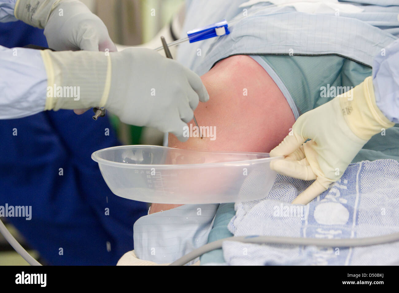 Chirurgie Du Genou Banque d'image et photos - Alamy