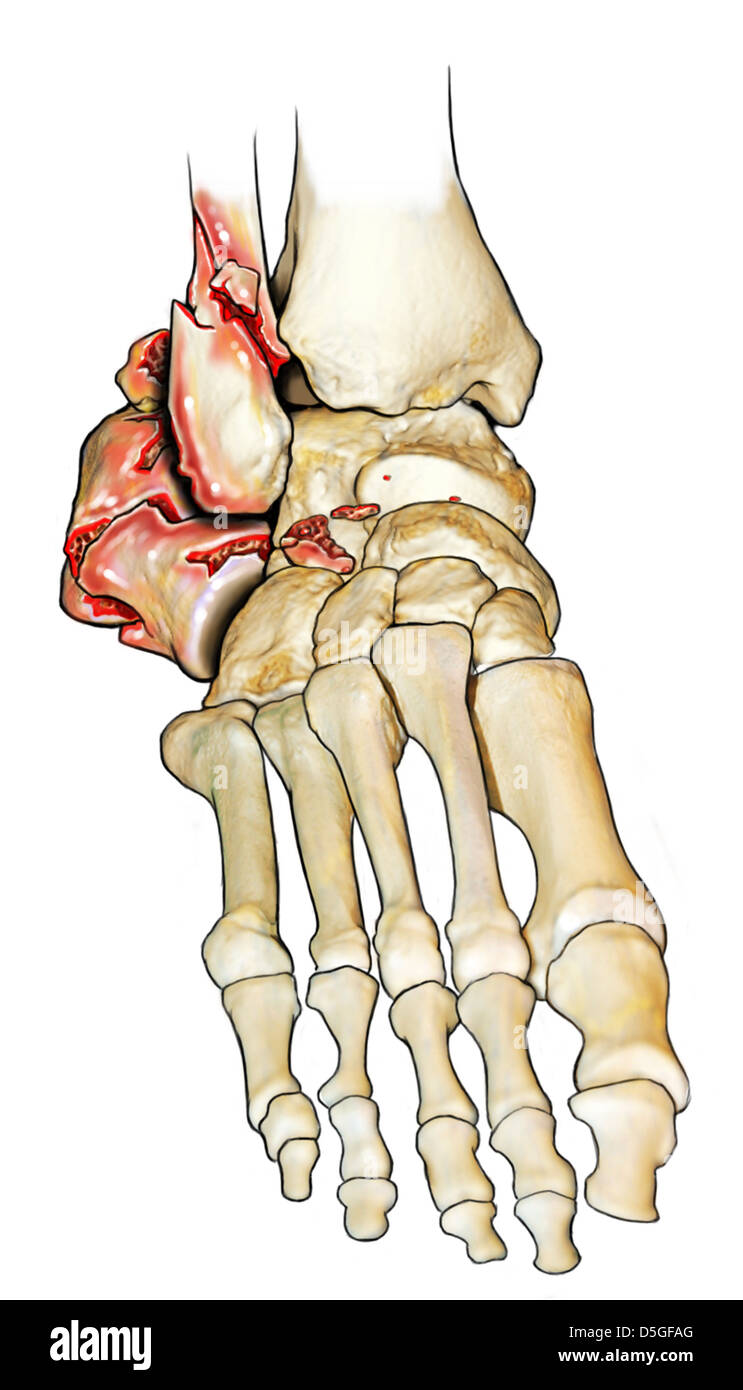 Calcaneus fracture Banque de photographies et d’images à haute ...