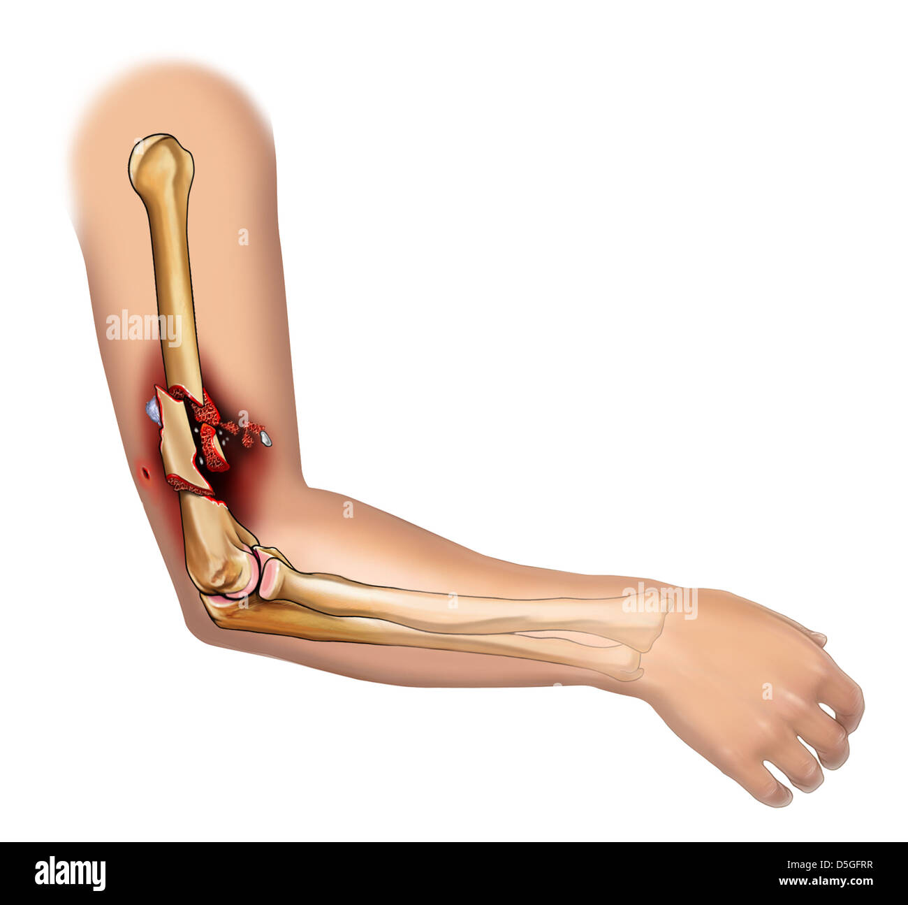 Comminuted fracture arm Banque de photographies et d’images à haute ...
