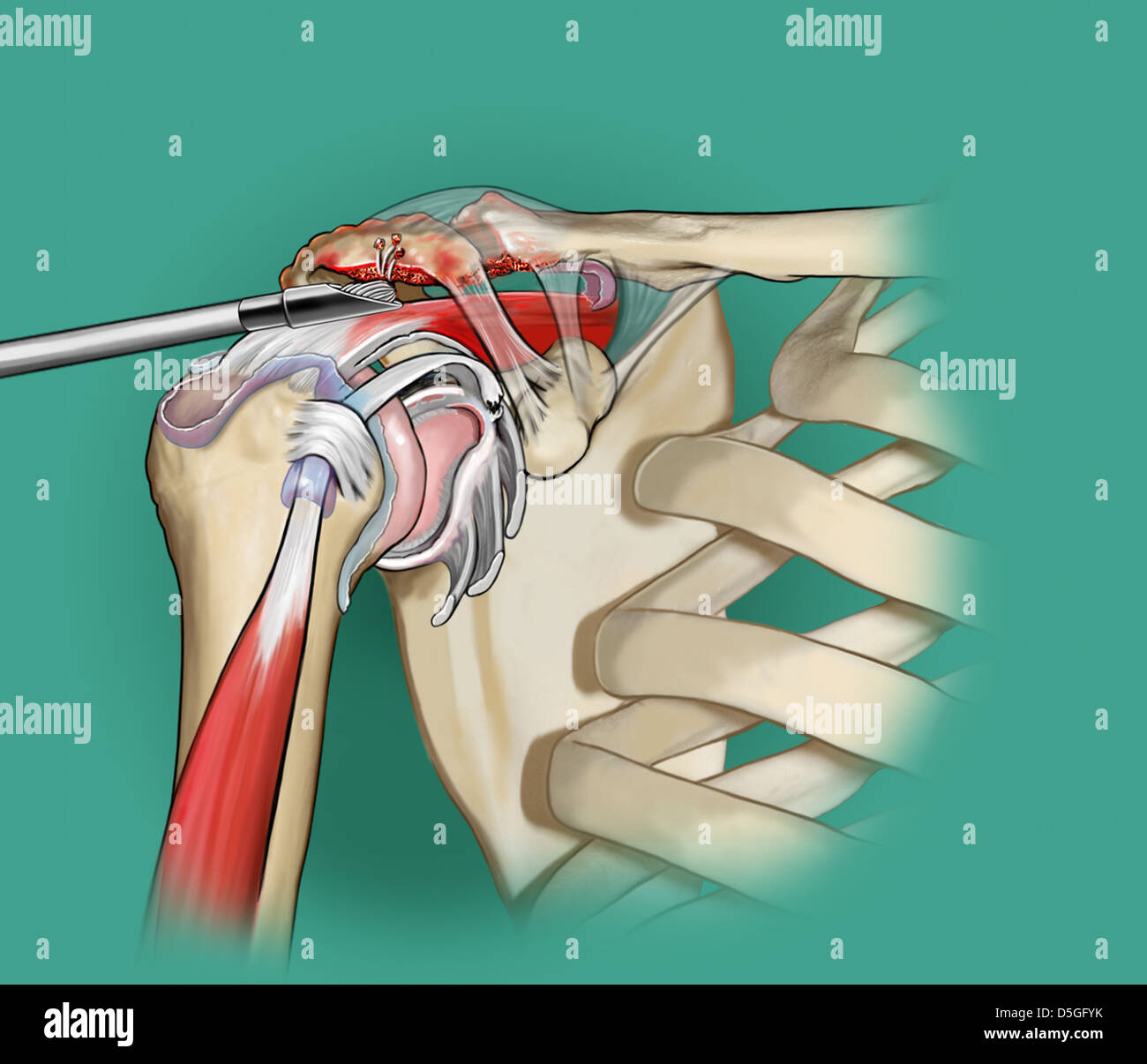 Débridement chirurgical Banque de photographies et d’images à haute ...