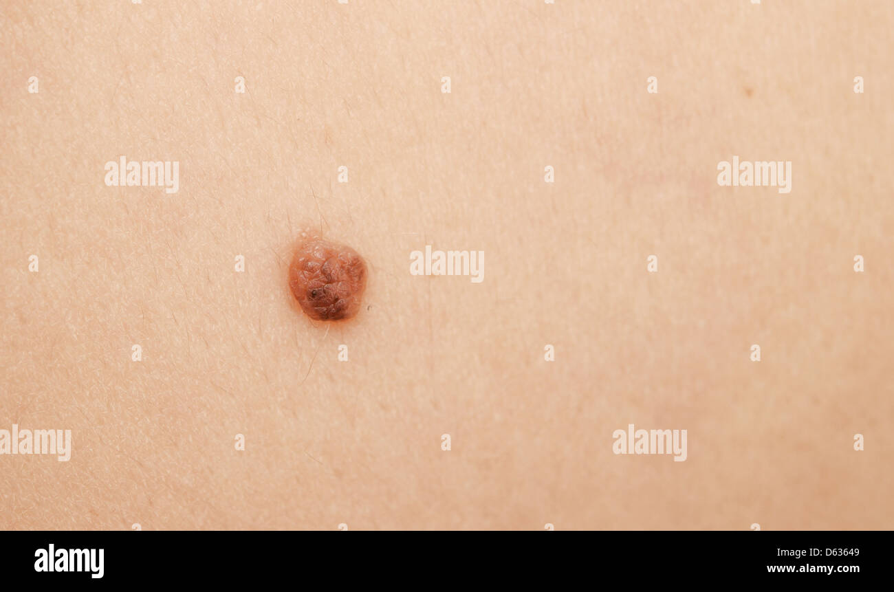 Benign mole Banque de photographies et d’images à haute résolution - Alamy