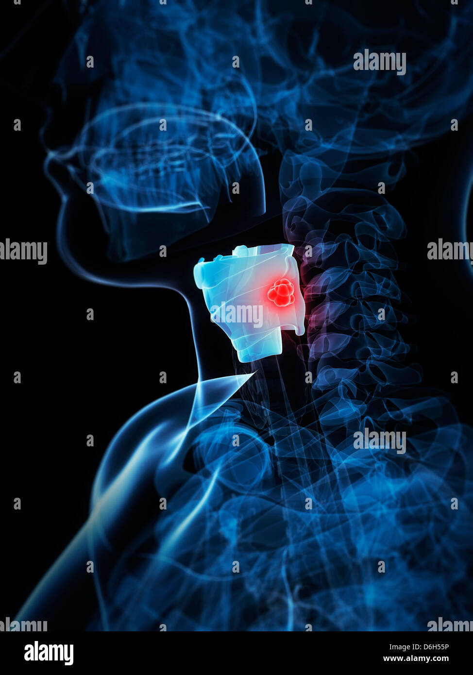 Cancer de la gorge Banque de photographies et d’images à haute ...