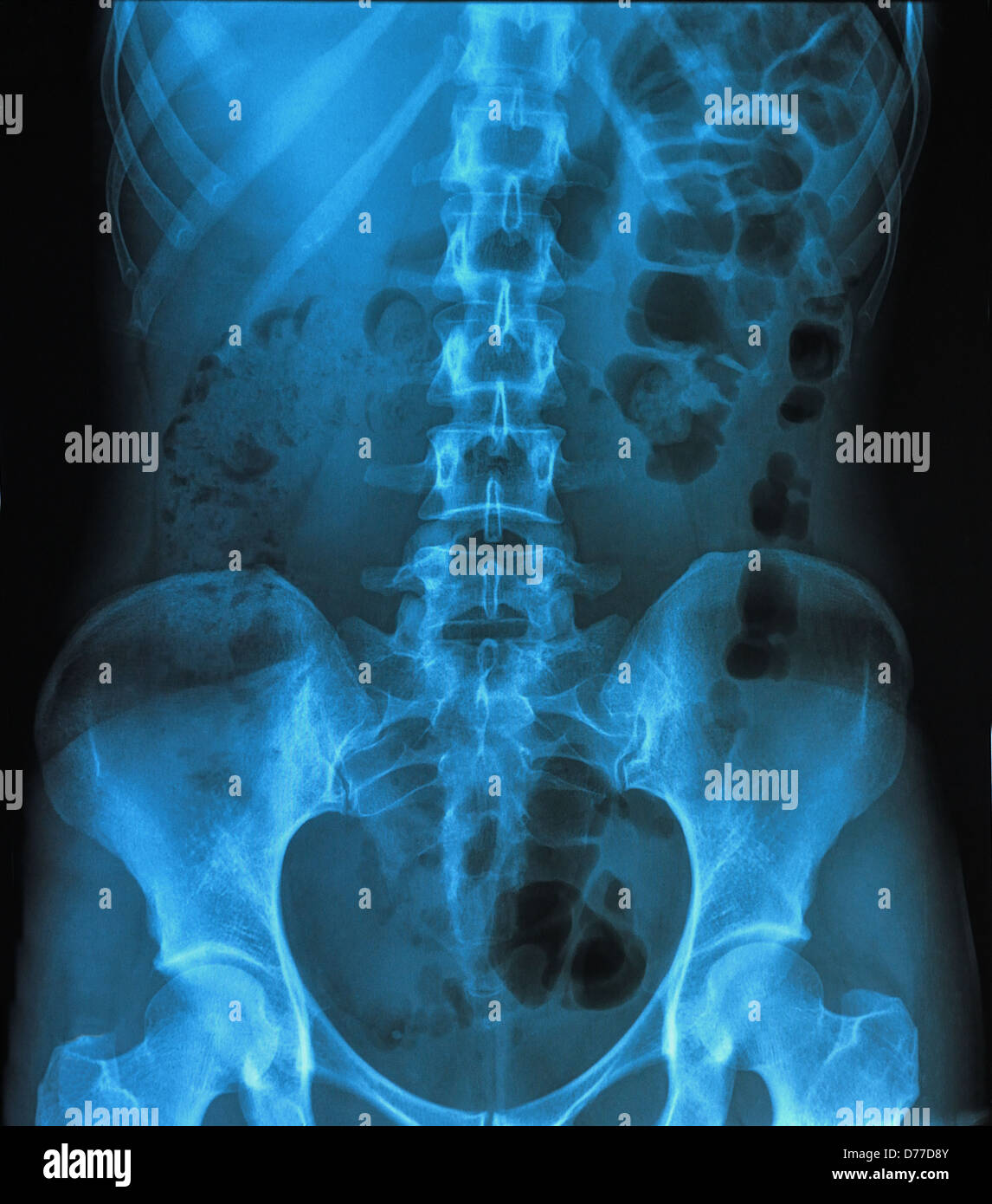 Radiographie de la colonne vertebrale Banque de photographies et d ...