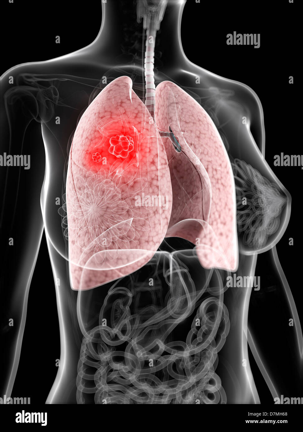 Maladie pulmonaire cancer de la tumeur Banque de photographies et d’images à haute résolution ...