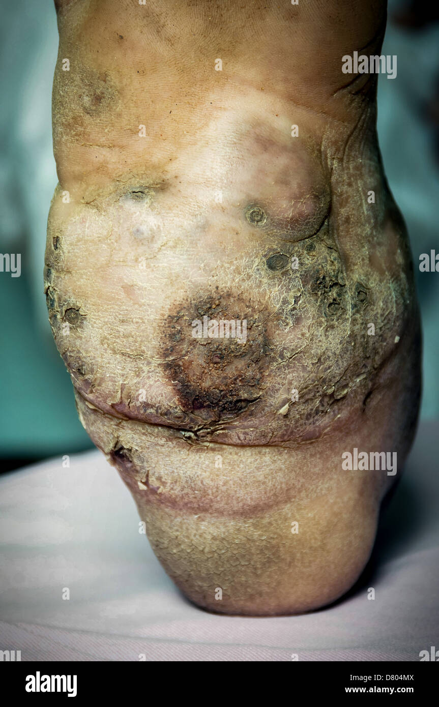 Maladies de la peau Banque de photographies et d’images à haute ...