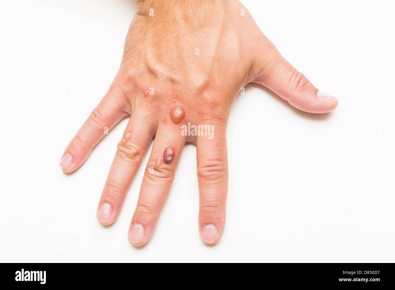 La main de l'homme couvert de cloques causées par la cryochirurgie ...