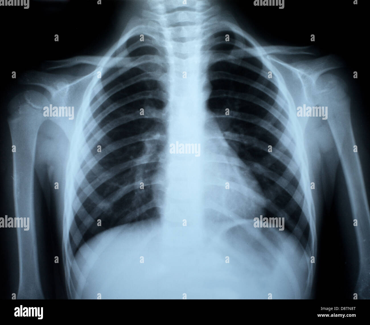 Radiographie de fracture de côte Banque de photographies et d’images à ...