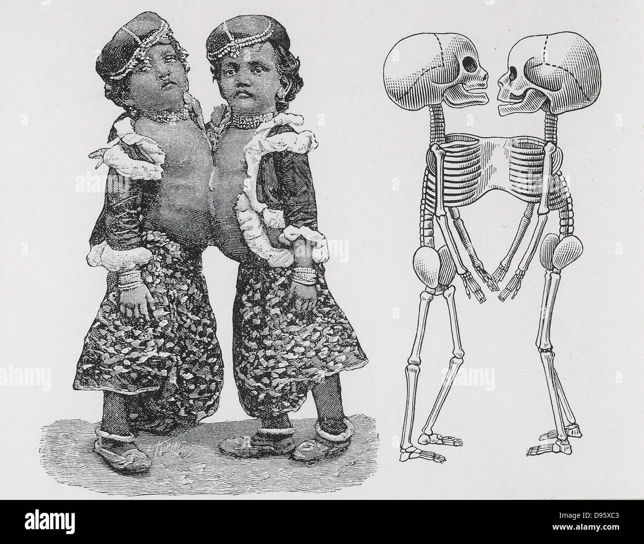 Jumeaux siamois radica et doodica Banque de photographies et d’images à ...