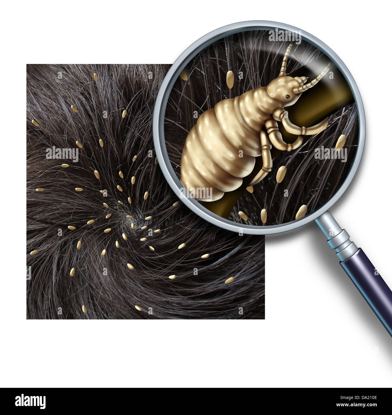 Problème de poux en tant que concept médical d'une loupe Close up d'une ...