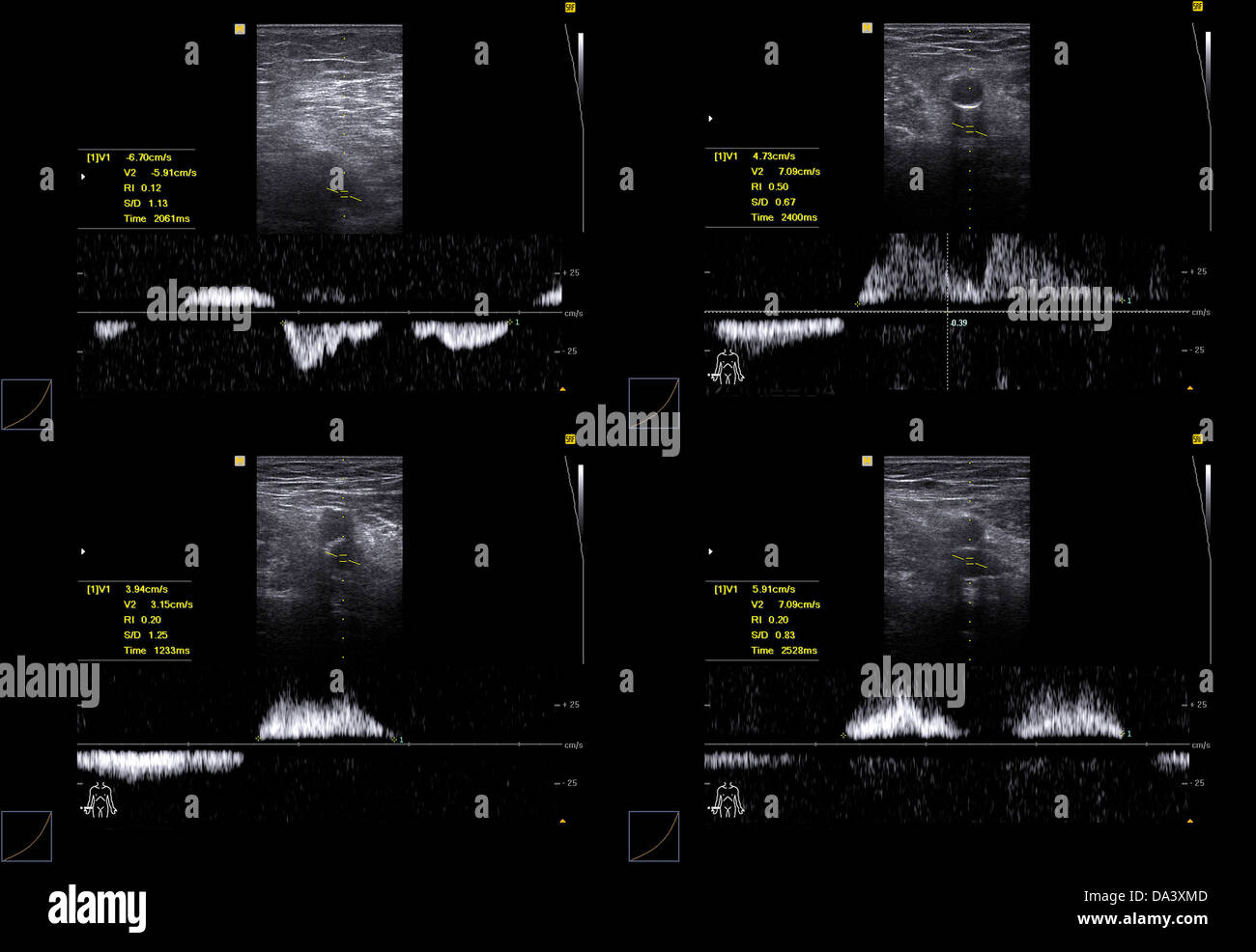 Reflux flux veineux démontré par échographie Döppler pulsé Photo Stock ...