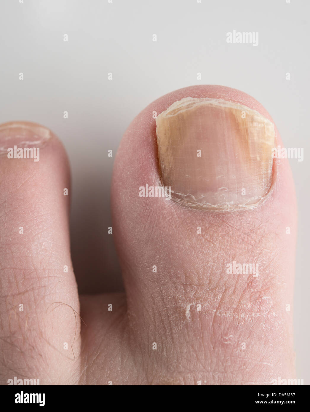 Infection fongique des ongles Banque de photographies et d’images à ...